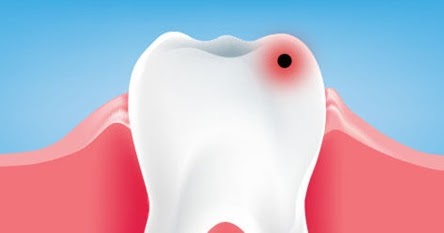 Causes, Symptoms, Prevention and Treatment of Dental Caries