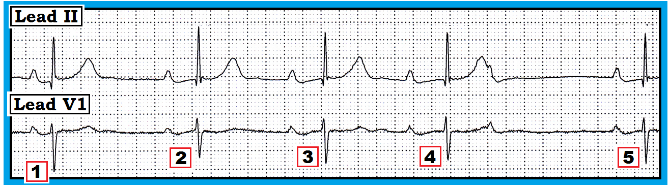 ECG Interpretation: ECG Interpretation Review #61 (AV Block – Mobitz I ...