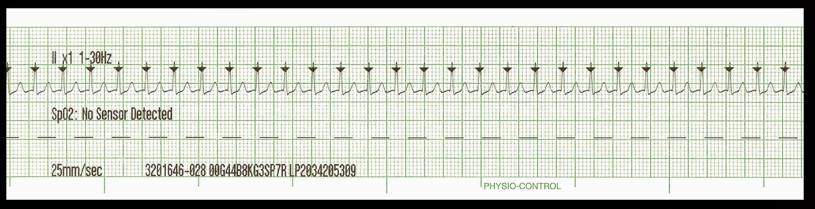 Practice EKG Strips 418