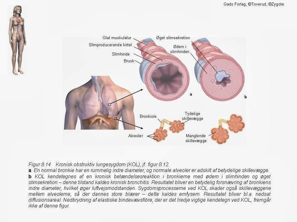 Kom Og Lev: Kronisk Obstruktiv Lungesygdom - KOL
