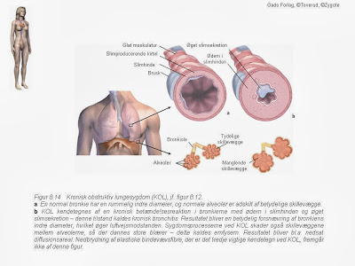 Kom Og Lev: Kronisk Obstruktiv Lungesygdom - KOL