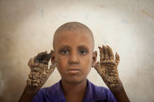 Human tree: Meet the 7-year-old boy suffering from a rare condition ...