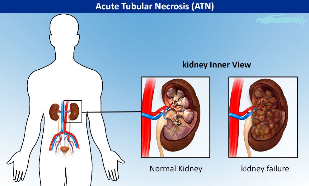 Prepare for Medical Exams : A Case Of Acute Tubular Necrosis