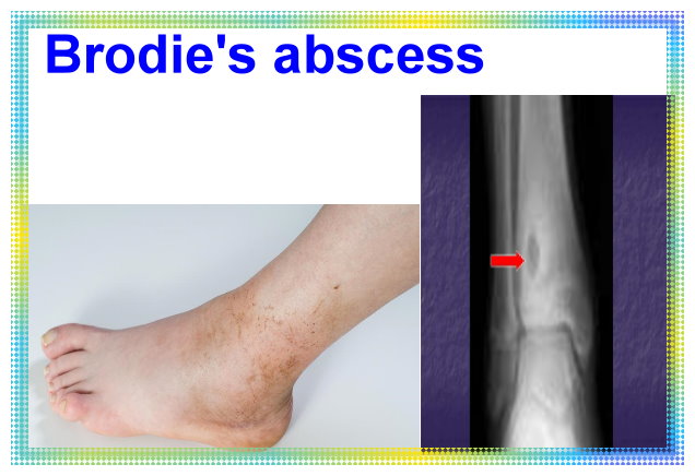 Brodie's abscess - Sure Developers Team