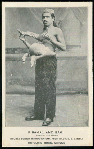 Enfermería y Salud: Siameses: Gemelos Parásitos o Heterópagos