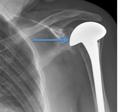 UW Shoulder and Elbow Academy: Reverse total shoulder arthroplasty ...