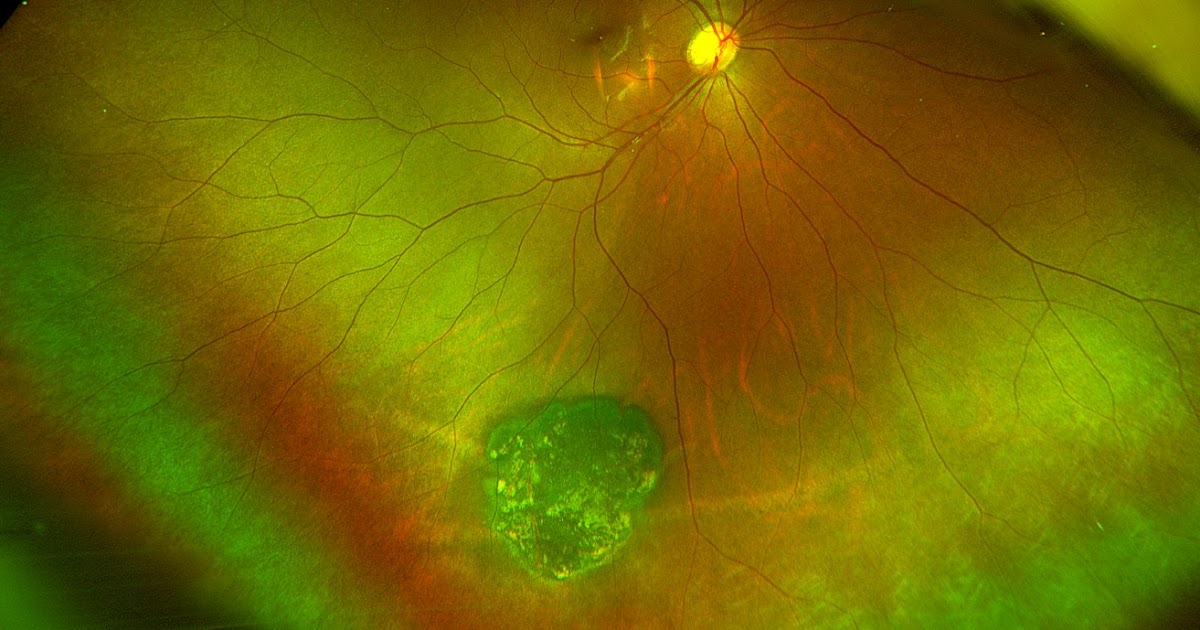 Sonoran Desert Eye Center: CONGENITAL HYPERTROPHY OF THE RETINAL ...