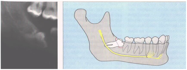 Dentistry and Medicine: Surgical management of Unerupted and Impacted teeth