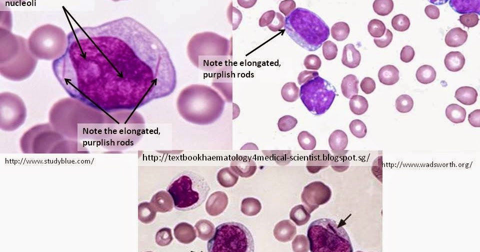 Haematology in a NutShell: Myeloblastic Auer Rods