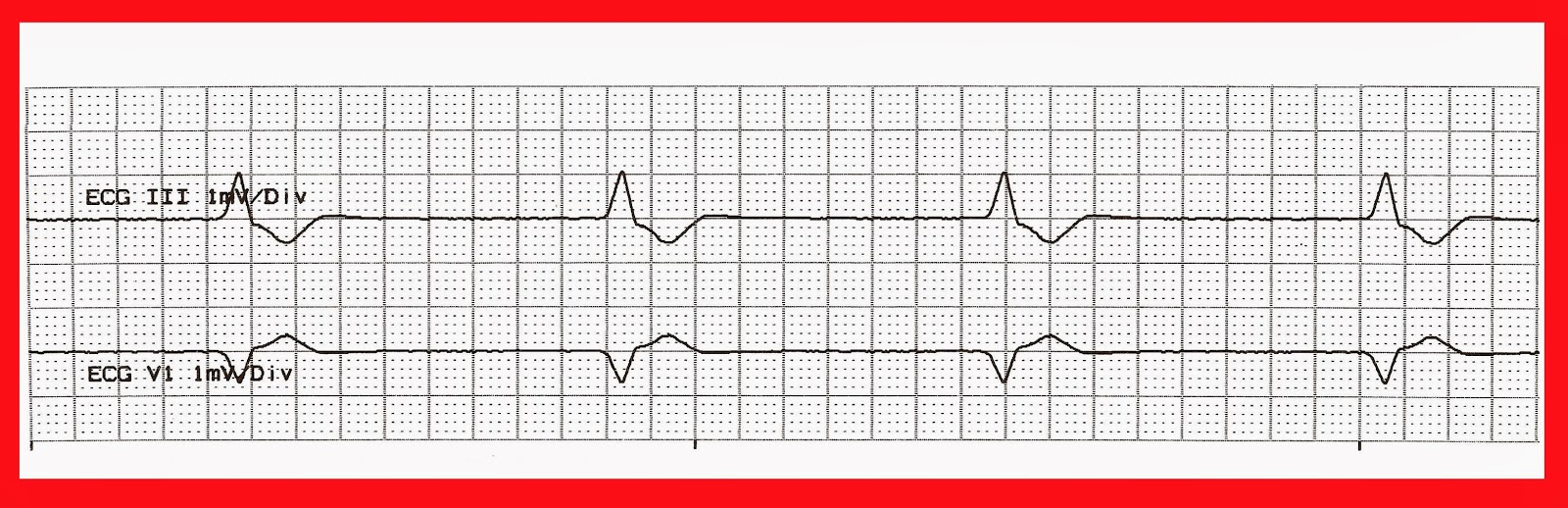 EKG Rhythm Quiz 278: Ventricular Rhythms
