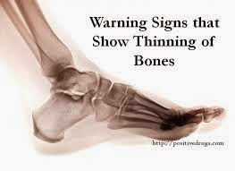 Emerson Villela Carvalho Jr., M.D.: The Dangers of Thinning Bones as ...