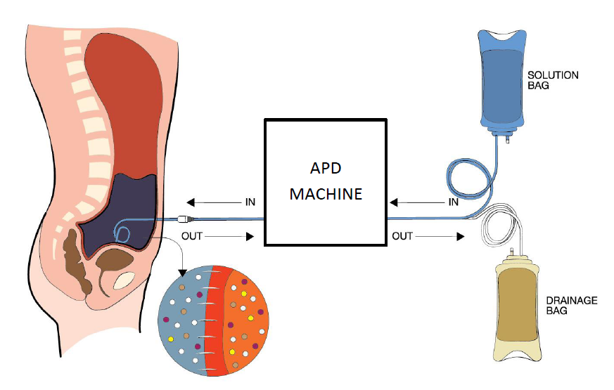 Interesting Green: Dialysis - How it's performed