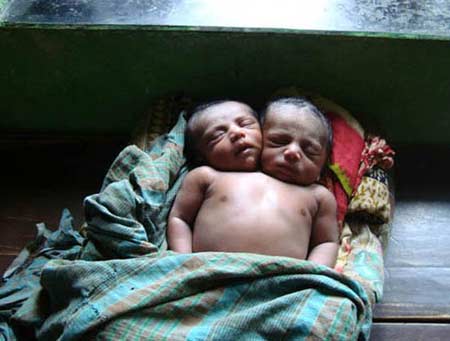 ABOUT BANGLADESH PICTURE: TWO HEADED BABY BORN IN BANGLADESH