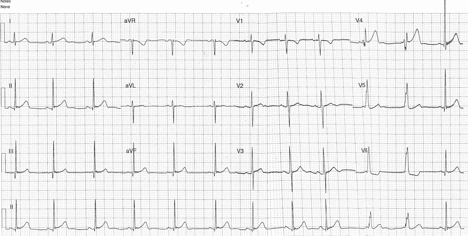 ECG of the Week: ECG of the Week - 8th May 2017 - Interpretation