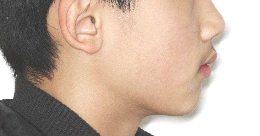 Bimaxillary Protrusion Definition, Symptoms, Causes, Braces, Surgery ...