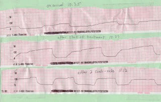 The Hypoxic Drive: Graphical Representations of Hypoxic Drive