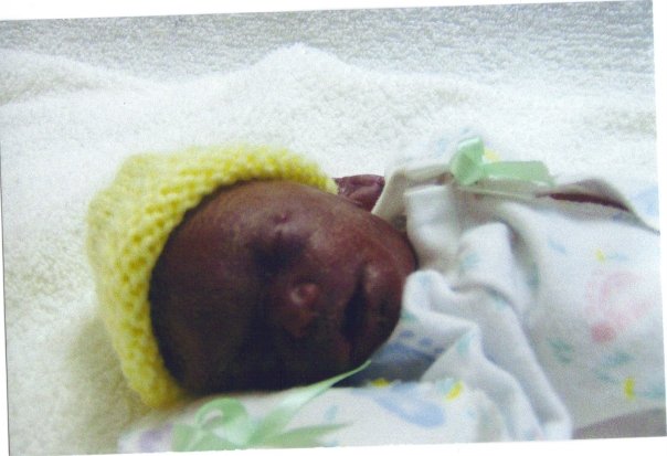 Elijah the Amazing Micropreemie Miracle!: My TTTS story....