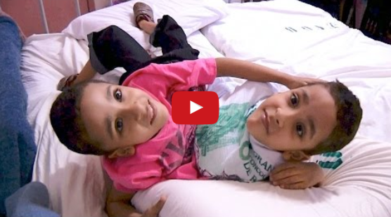 Conjoined Twins Await Separation - Body Bizarre Episode 6 Teaser « Cutegirl