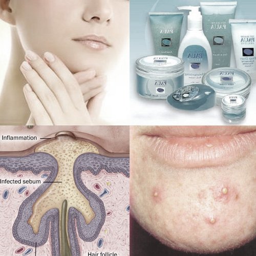 World's Shocking News: The proper hygiene when having acne problems