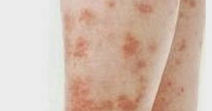 Warts on Legs - How to Remove Leg Warts with Salicylic Acid and Duct ...