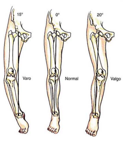 Rodillas Genu-Varo Terapia En Casa, 42% OFF