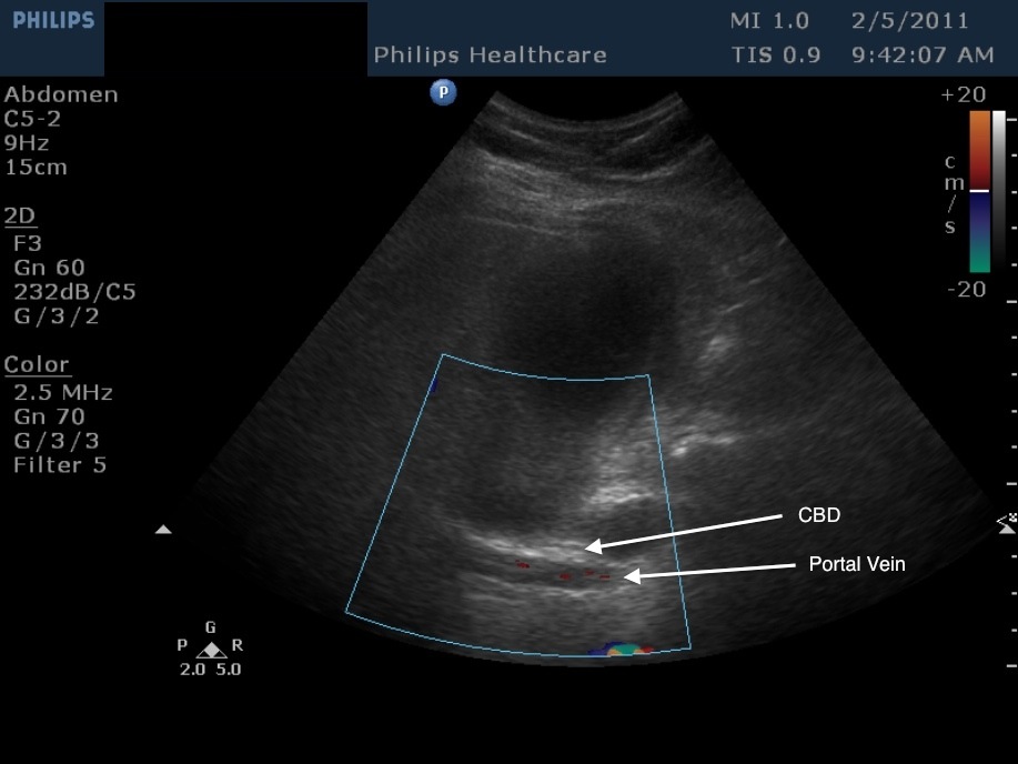 Acute Cholecystitis ~ Ultrasound Cases Info