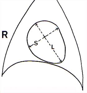 Imacardio: El Vertebral Heart Score (Índice cardiaco vertebral)