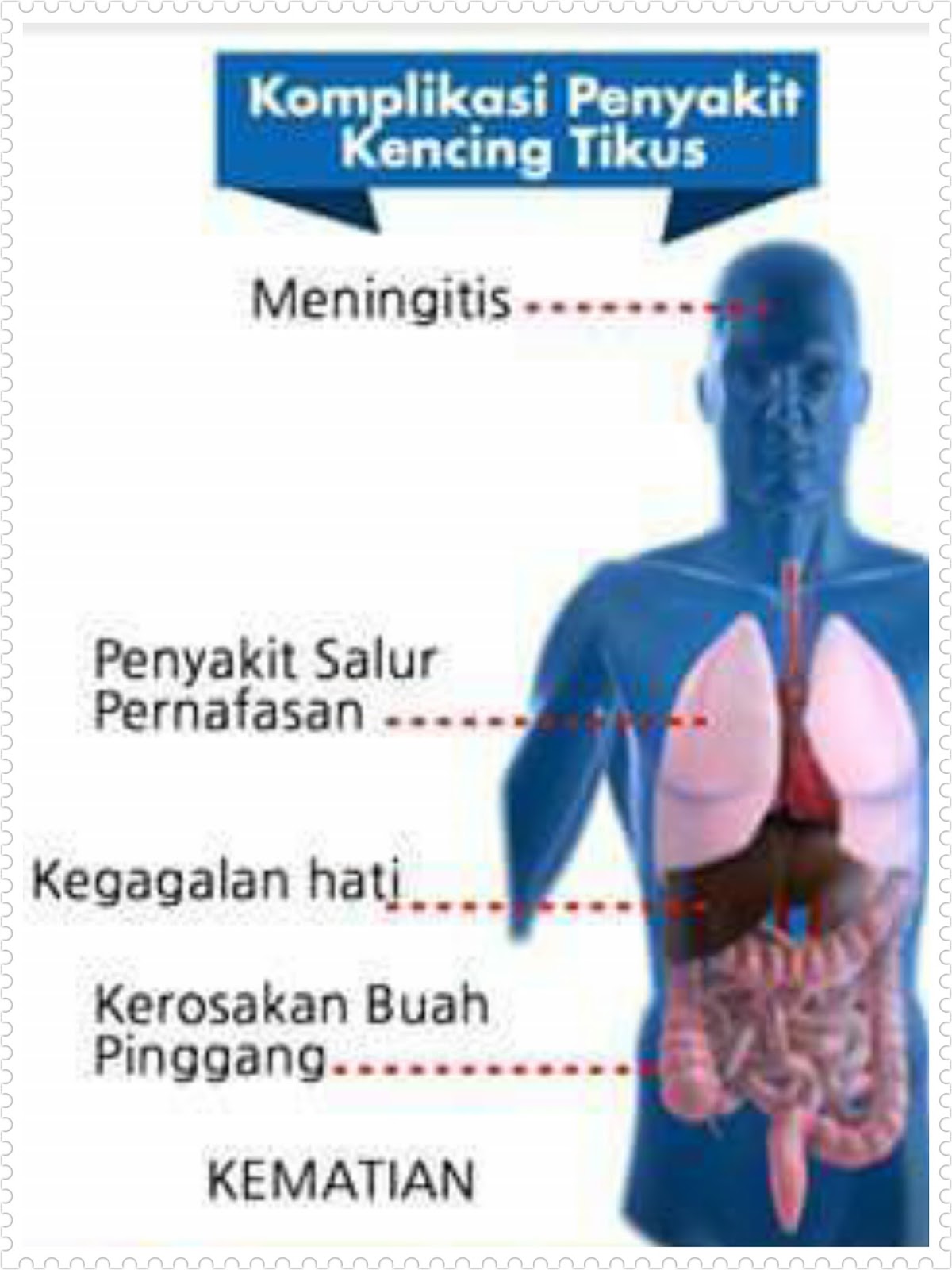 3D health beauty supplement: KENALI SIMPTOM,GEJALA DAN KOMPLIKASI ...