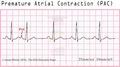 ECG Educator Blog : Atrial Rhythms