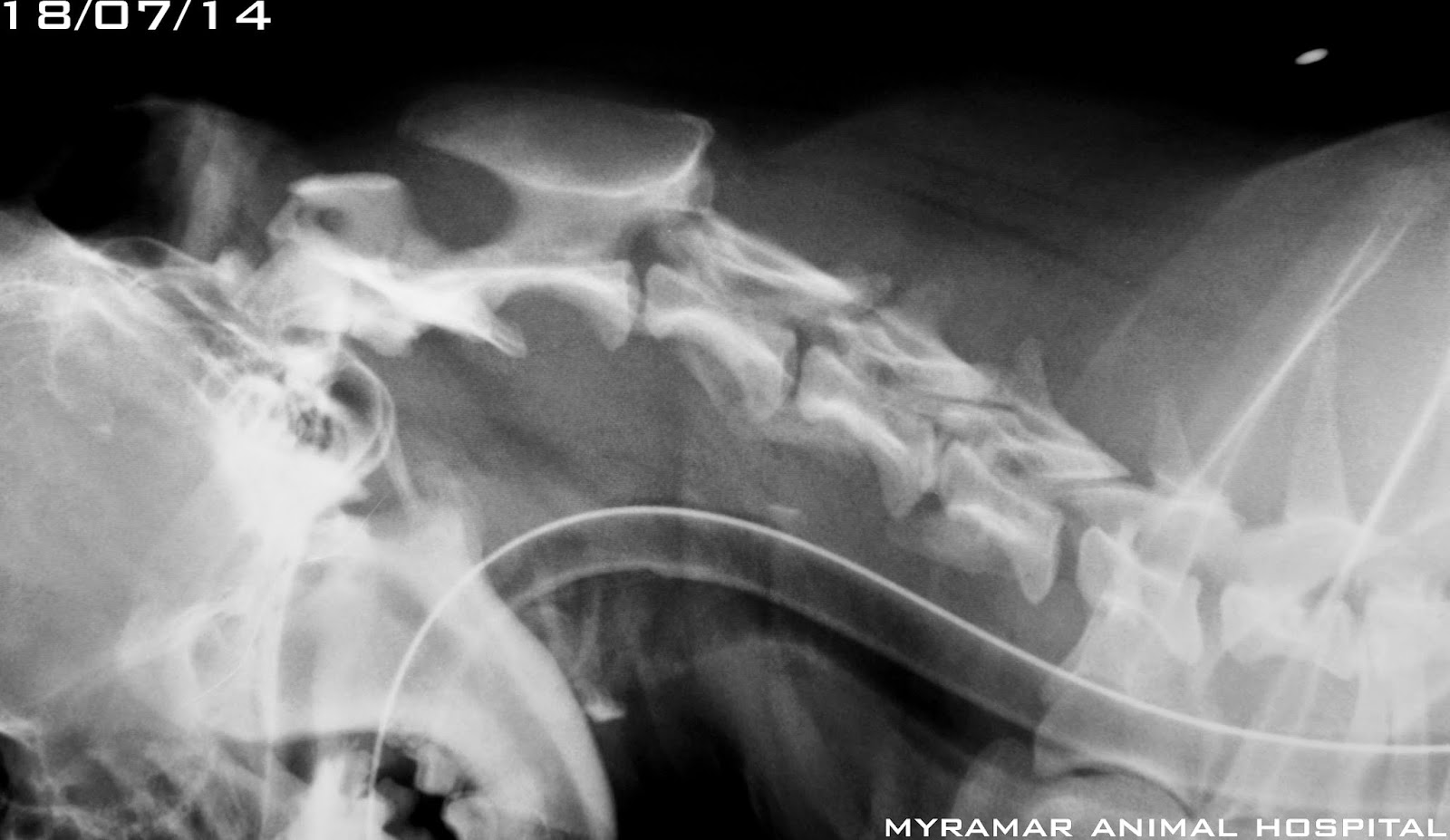 CIRUGÍA DE COLUMNA: ANTONIO. C4-C5. Slot cervical