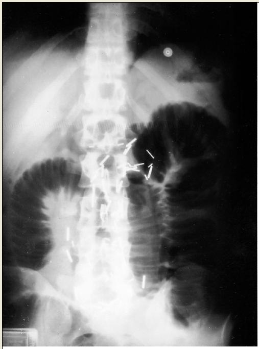 Approach to patient with ileus and Obstruction