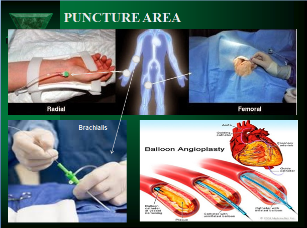 MATERI KARDIOLOGI DASAR RSWS 2015: Percutaneous Coronary Intervention (PCI)