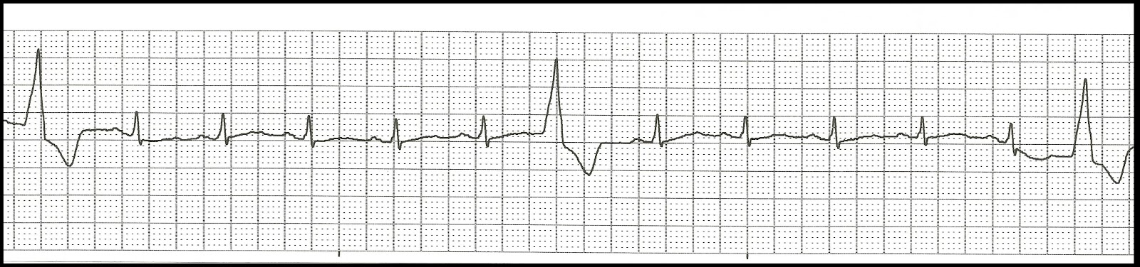 Practice ECG Rhythm Strips 100