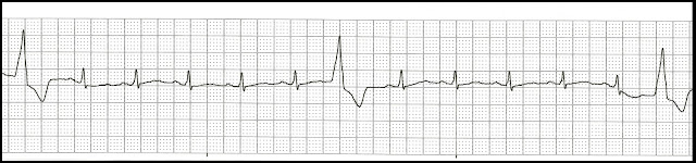Practice ECG Rhythm Strips 100