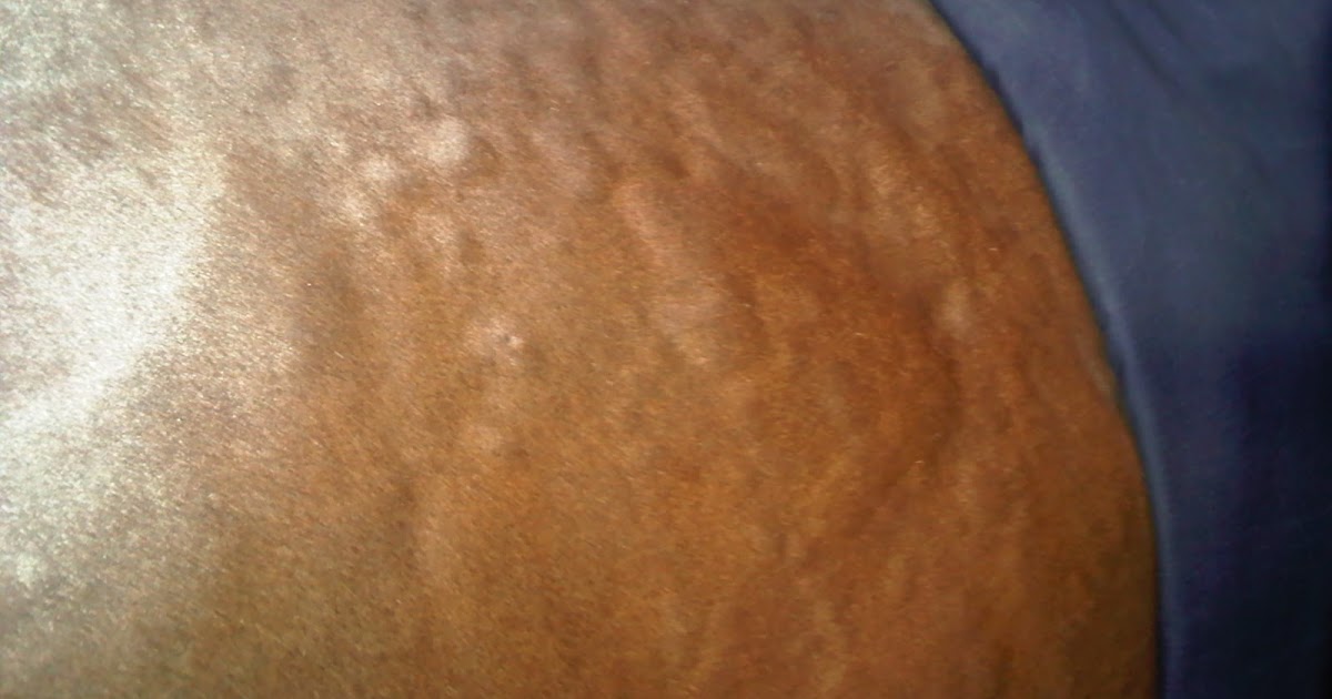 Care-Line Corner: Lumpy bumpy bits!