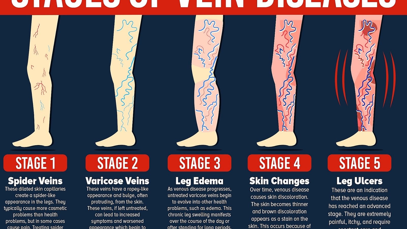 Treatment For Veins On Legs Treat Choices
