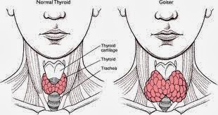 SISTEM ENDOKRIN : Hipertiroid