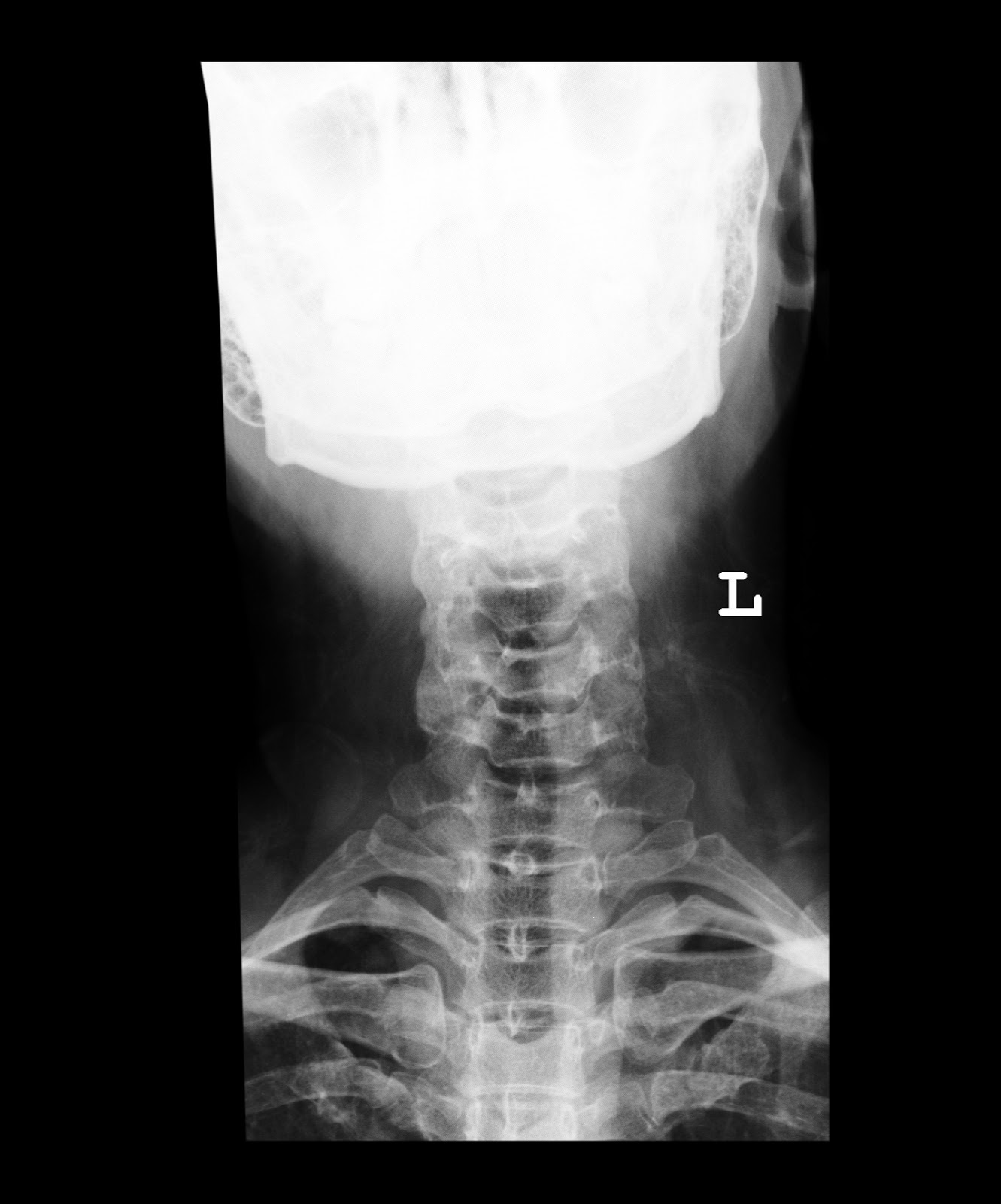 Oblique upper cervical spine x ray - modestat