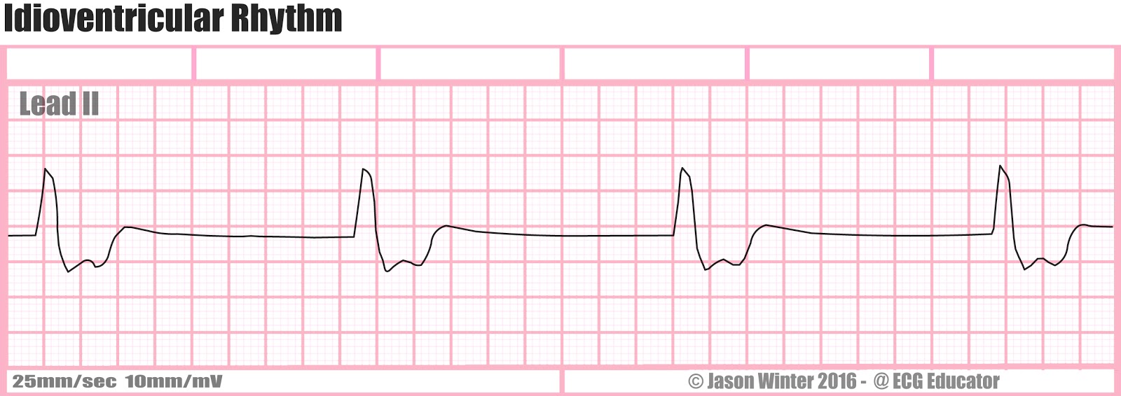 ECG Educator Blog : Ventricular Rhythms