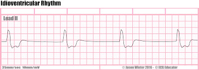 ECG Educator Blog : Ventricular Rhythms
