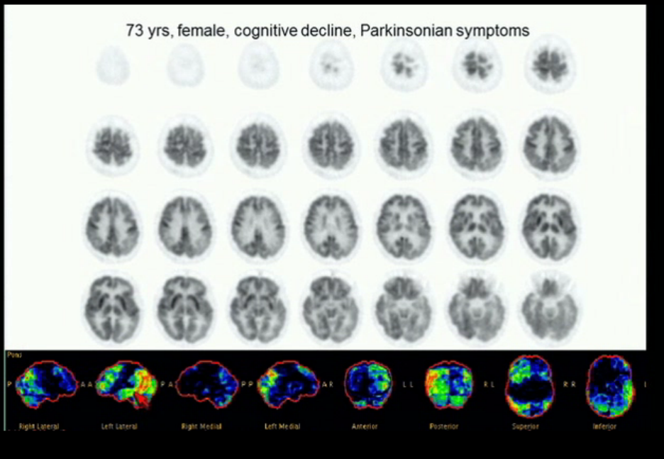rsna: FDG PET for dementia