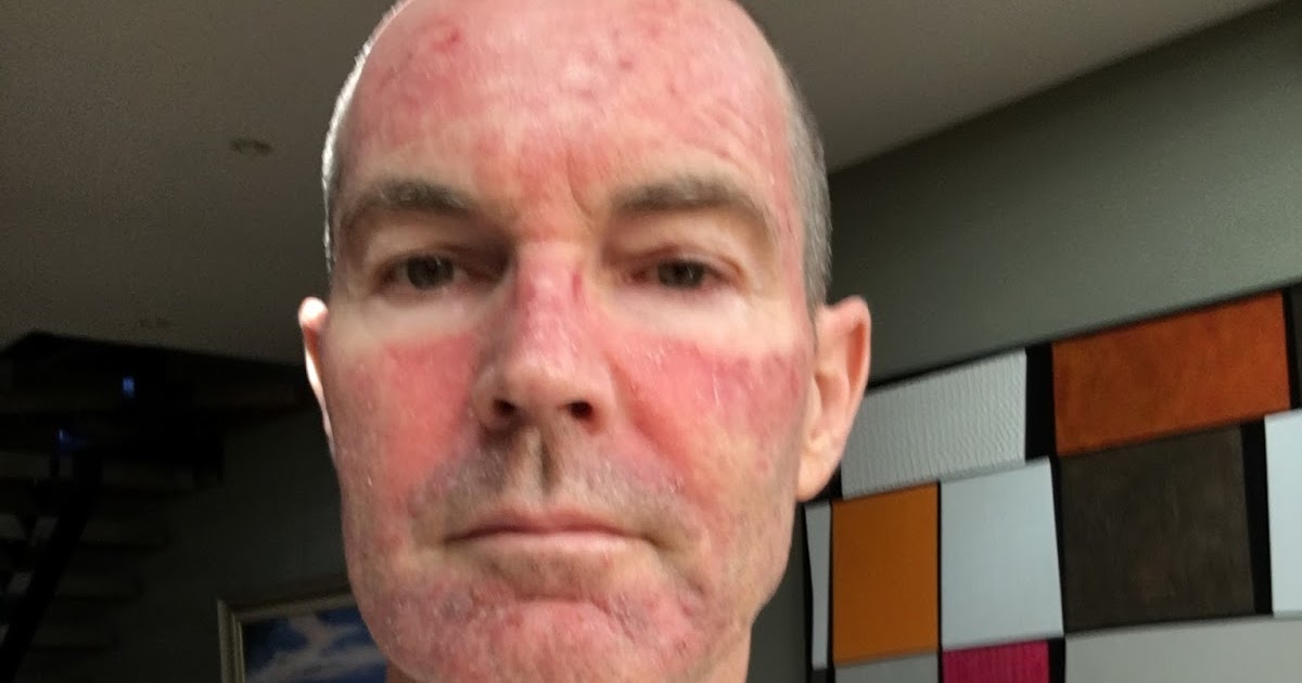 Efudix Treatment: Day 27 - Post day 8