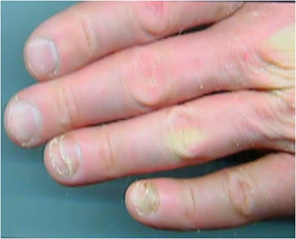 Modern Diagnostic Science: CAN YOUR NAILS IDENTIFY CANCER? - By: Dr ...