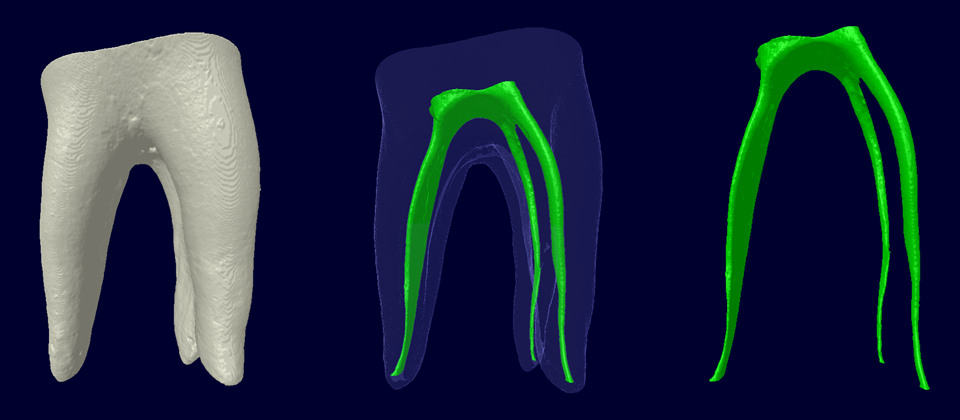 The Root Canal Anatomy Project: Root Canal Preparation: Gates-Glidden ...
