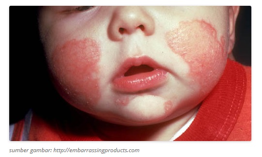 KESIAN BAYI INI DERITA EKSIMA... | PENAWAR UNTUK PENYAKIT KULIT SEPERTI ...