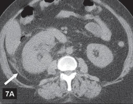 X-RAYview: PIELONEFRITE Aguda