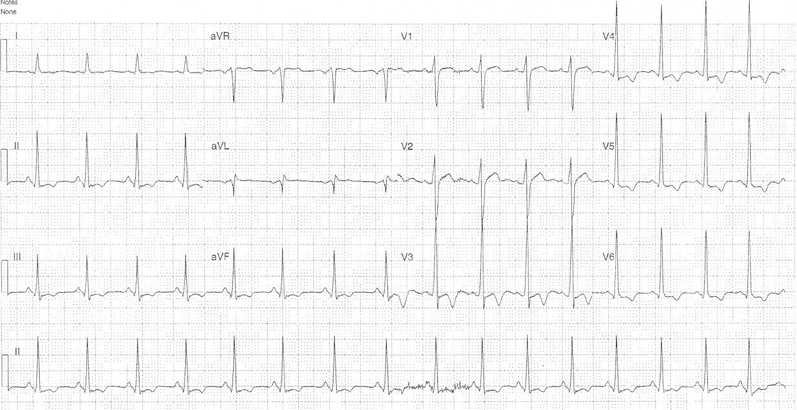 ECG of the Week: ECG of the Week - 6th November 2017 - Interpretation