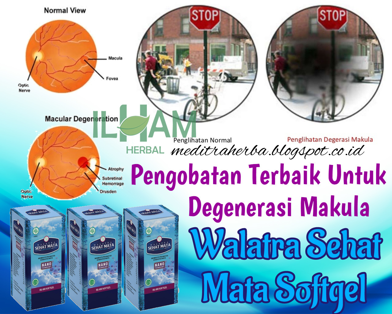 Obat Tradisional Degenerasi Makula Terbaik