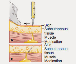 Intramuscular Injection Z-Track Method ~ Nursing