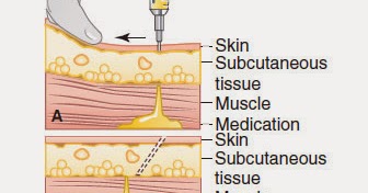 Intramuscular Injection Z-Track Method ~ Nursing